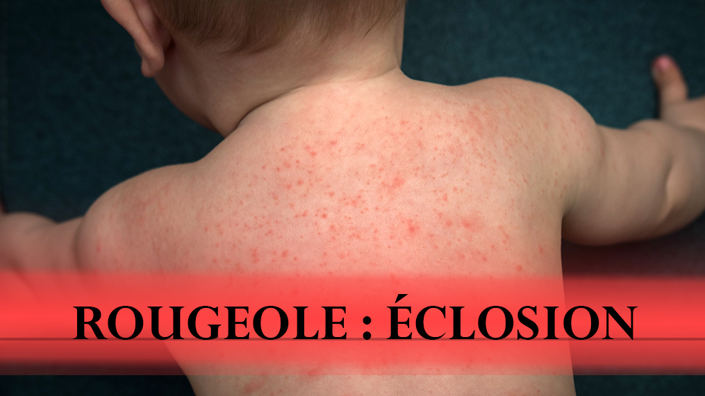 Sensibilisation à l'éclosion de la rougeole au Québec - Association des ...